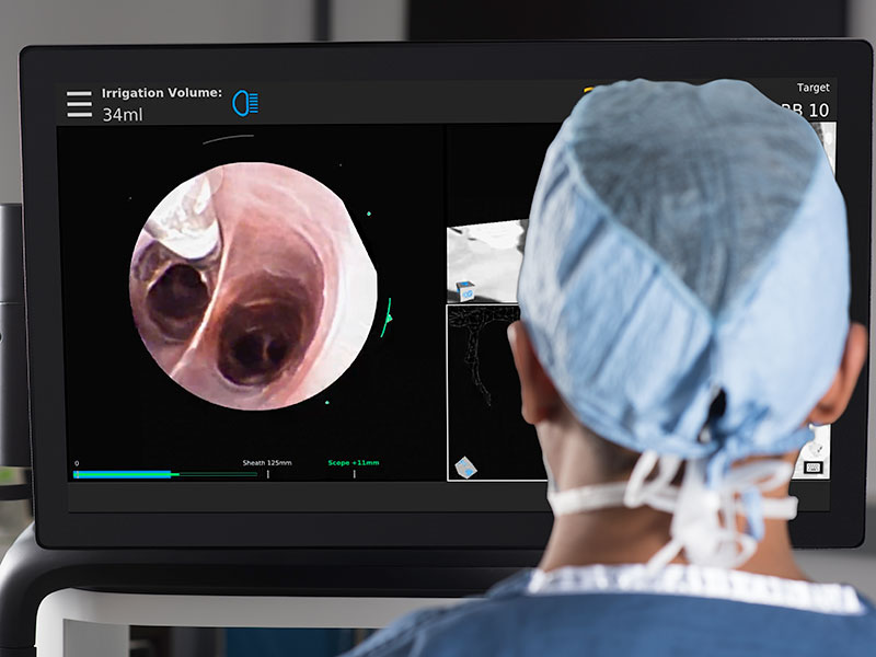 Sanford introduces better way to diagnose, treat lung cancer - Sanford ...