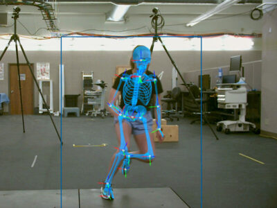 ACL injury is focus of Fargo researchers - Sanford Health News