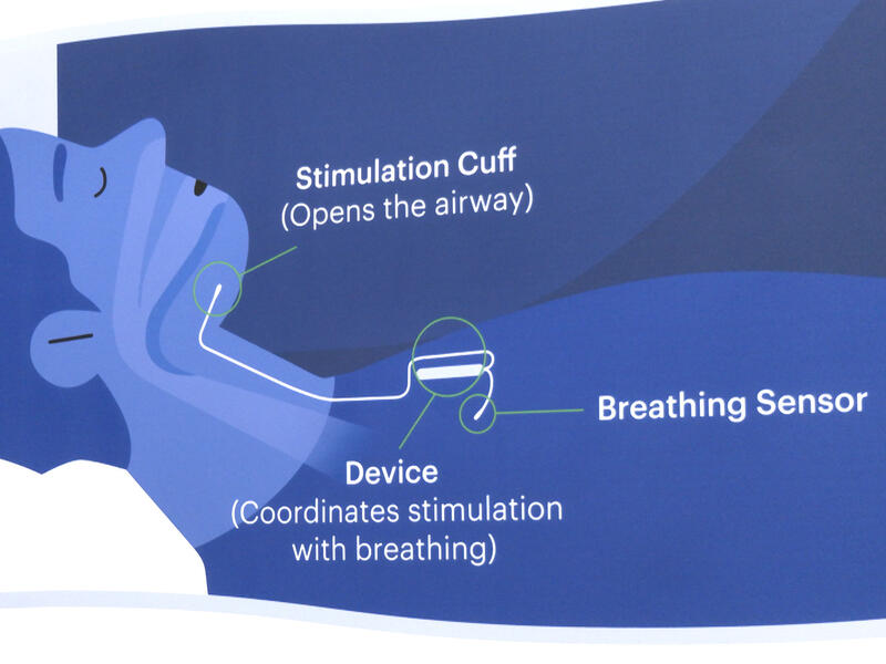 Sleep apnea device means sweet dreams for Bismarck woman - Sanford ...