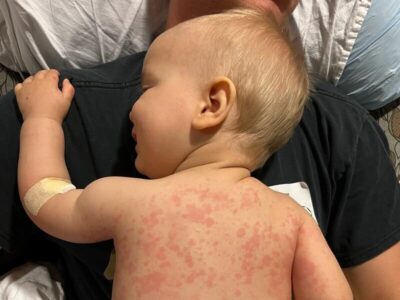 Rash, fever turn out to be signs of juvenile arthritis - Sanford Health ...