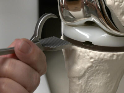 Fargo PA invents device for use in knee replacement surgery - Sanford ...